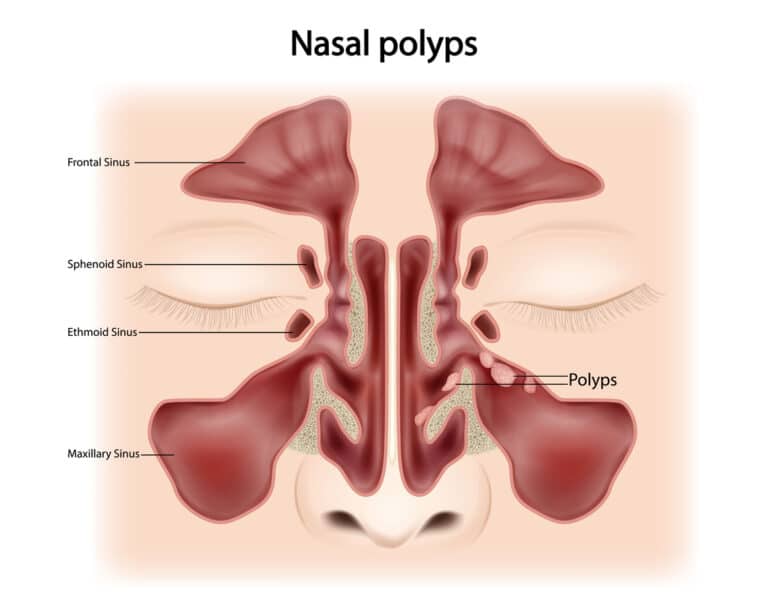 Polypectomy: Removing Nasal Polyps to Improve Airflow | Midwest Ear ...